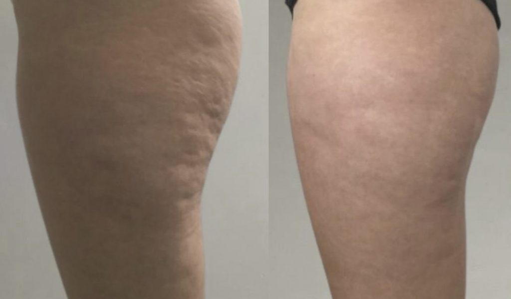 Cellulite Protocol | Specialist Skin Clinic | Nuriss