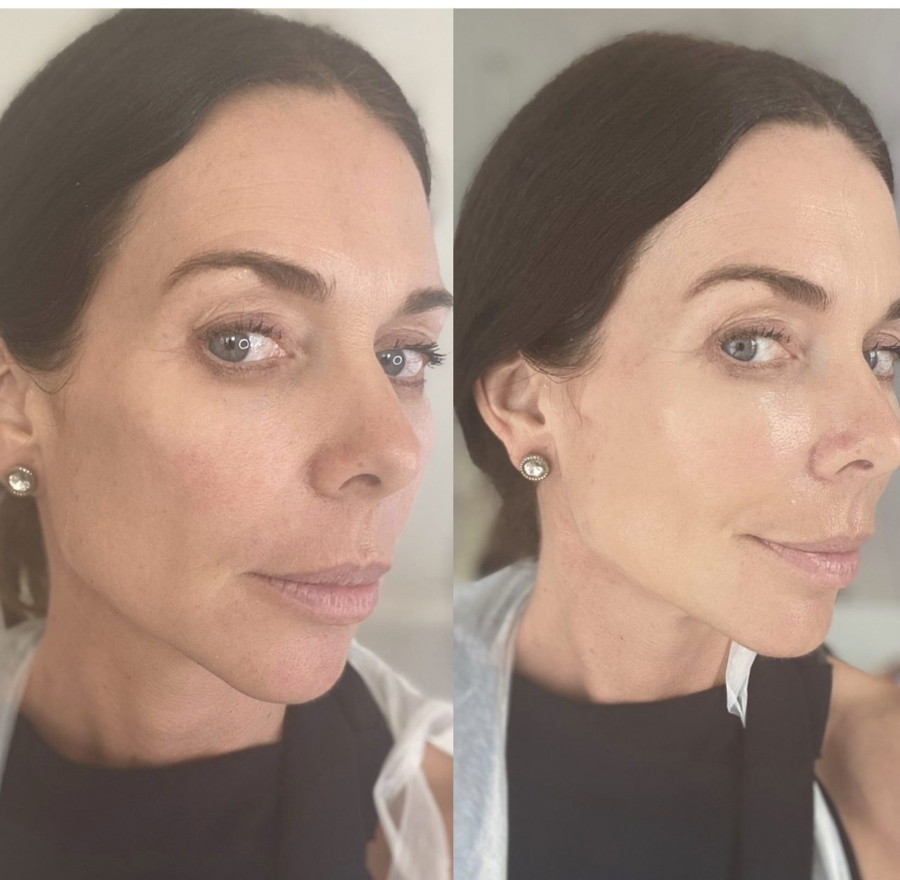 Profhilo Protocol | Specialist Skin Clinic | Nuriss